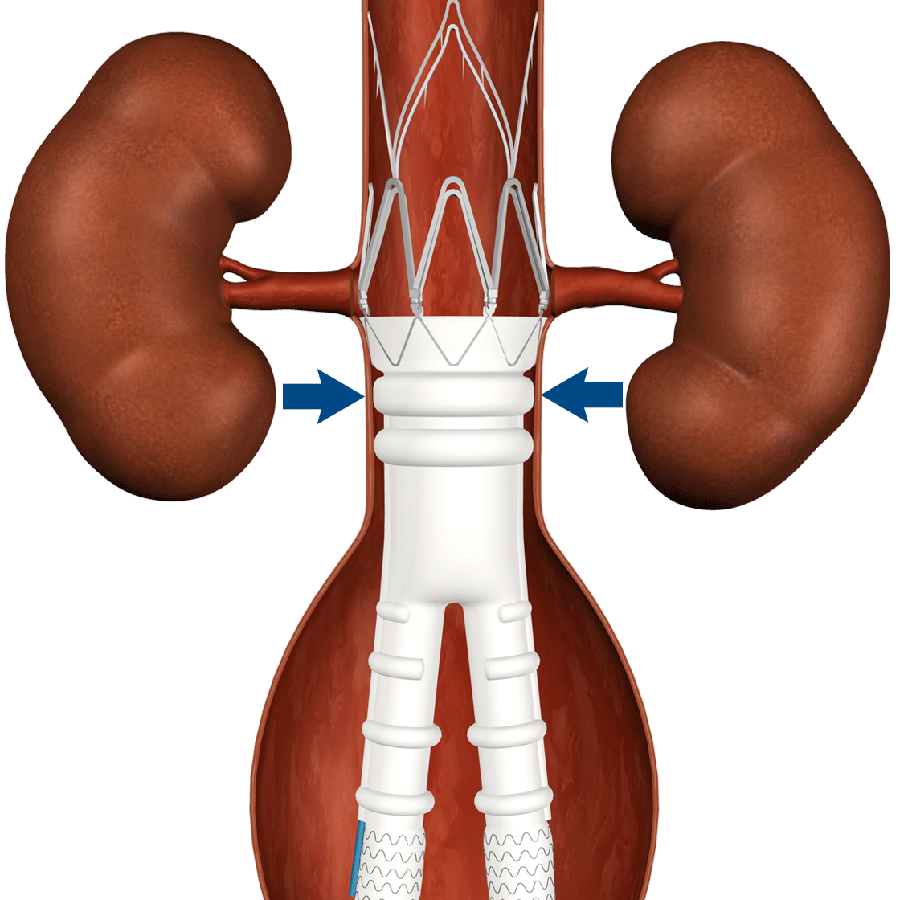 Endologix Announces First Patients Treated With Unique Stent Graft